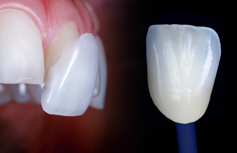 Veneers in Burlington CT - Dr. Bethaney Brenner DMD